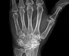 주상골 골절scaphoid Fracture 넘어진 뒤에 엄지 손가락 쪽 손목이 아파요 네이버 블로그